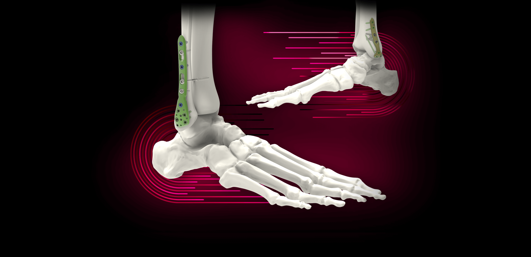 Activ Ankle - pour la cheville traumatique - Newclip Technics