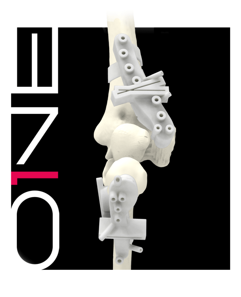 Fractures du Coude - Newclip Technics