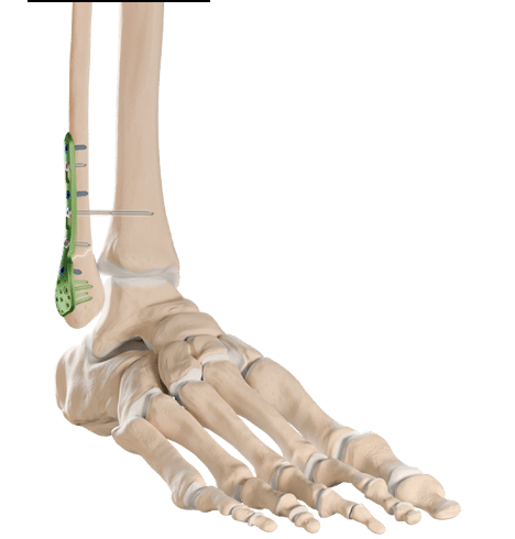 Les solutions pour la Cheville. - Newclip Technics