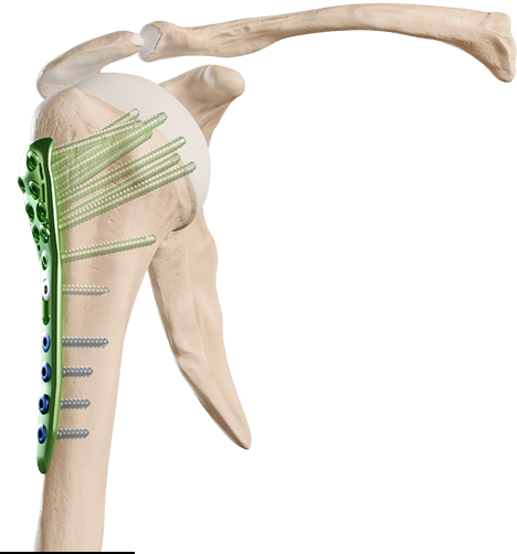 Solutions pour la chirurgie de l'épaule - Newclip Technics